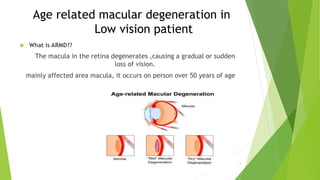 Armd cases in low vision | PPTX