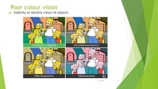 Armd cases in low vision | PPTX