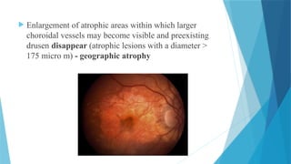 Age Related Macular Degeneration - ARMD | PPTX