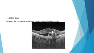 Age Related Macular Degeneration - ARMD | PPTX