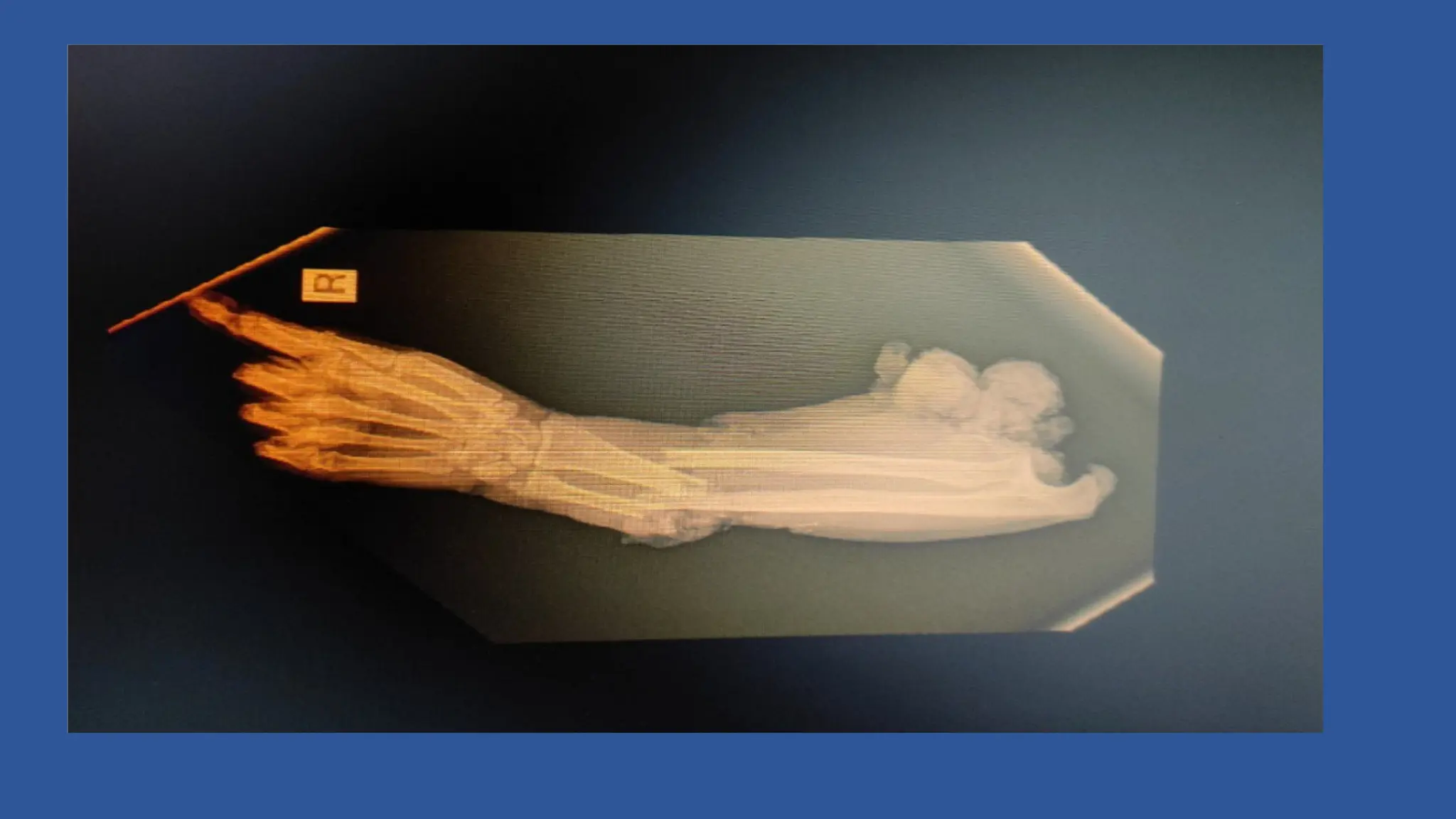 Arm Replantation -Systemic Reperfusion Injury.pptx