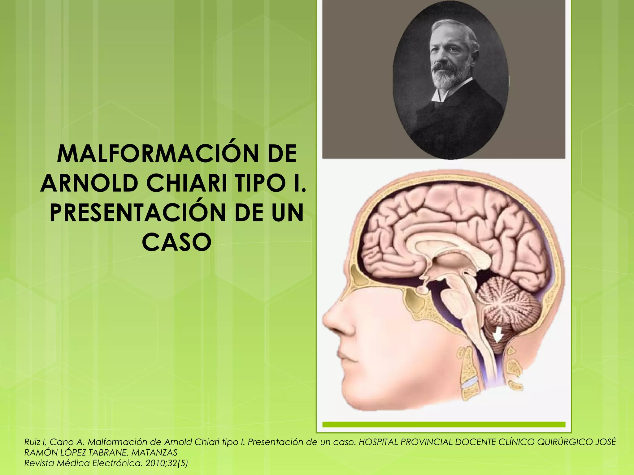Arnold chiari | PPT