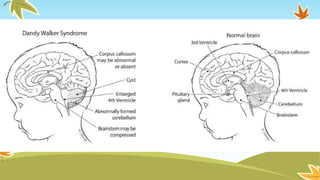 Arnold Chiari Malformation And Dandy Walker Syndrome.pptx