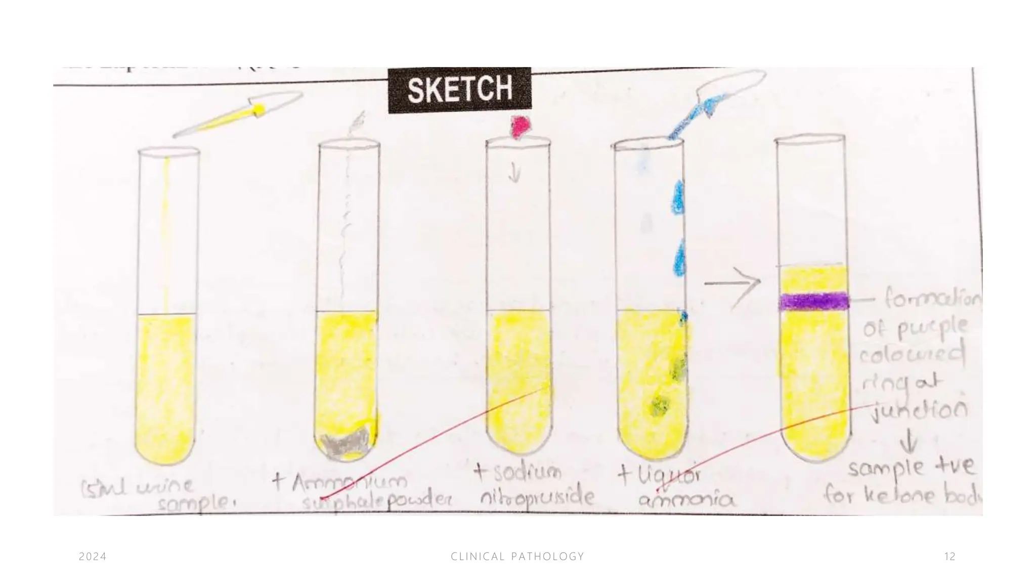 Ketone body examination in urine by Rother's Test | PPTX
