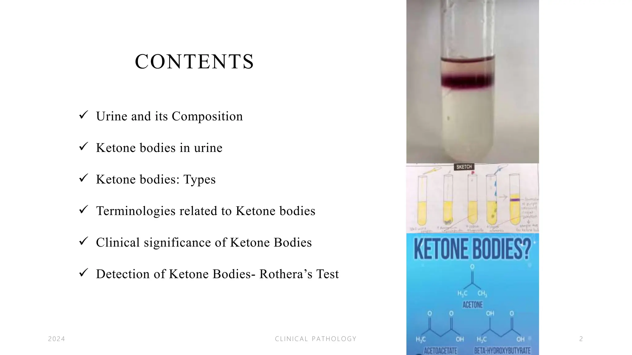 Ketone body examination in urine by Rother's Test | PPTX