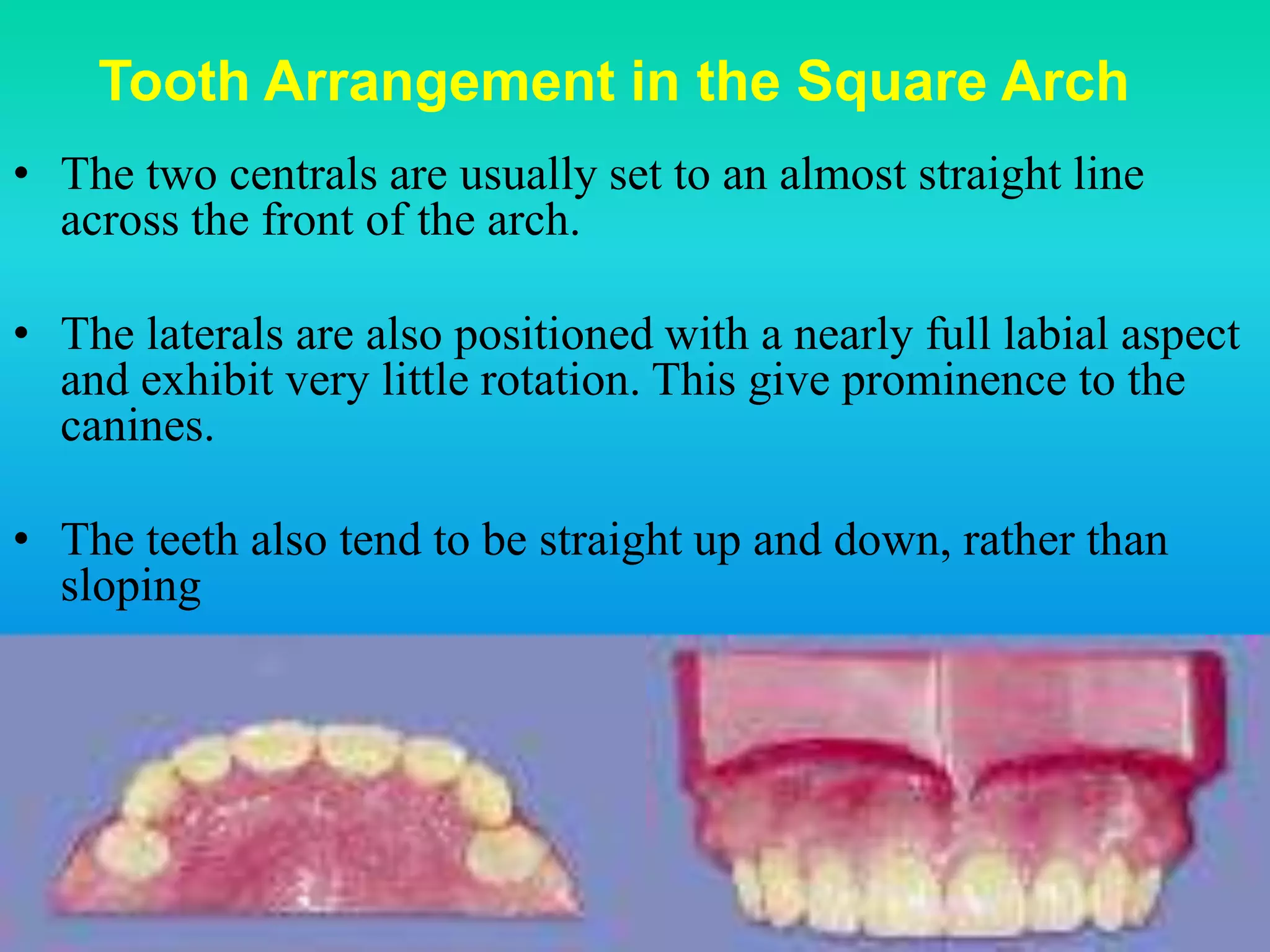 Arrangement of anterior artificial teeth | PPTX