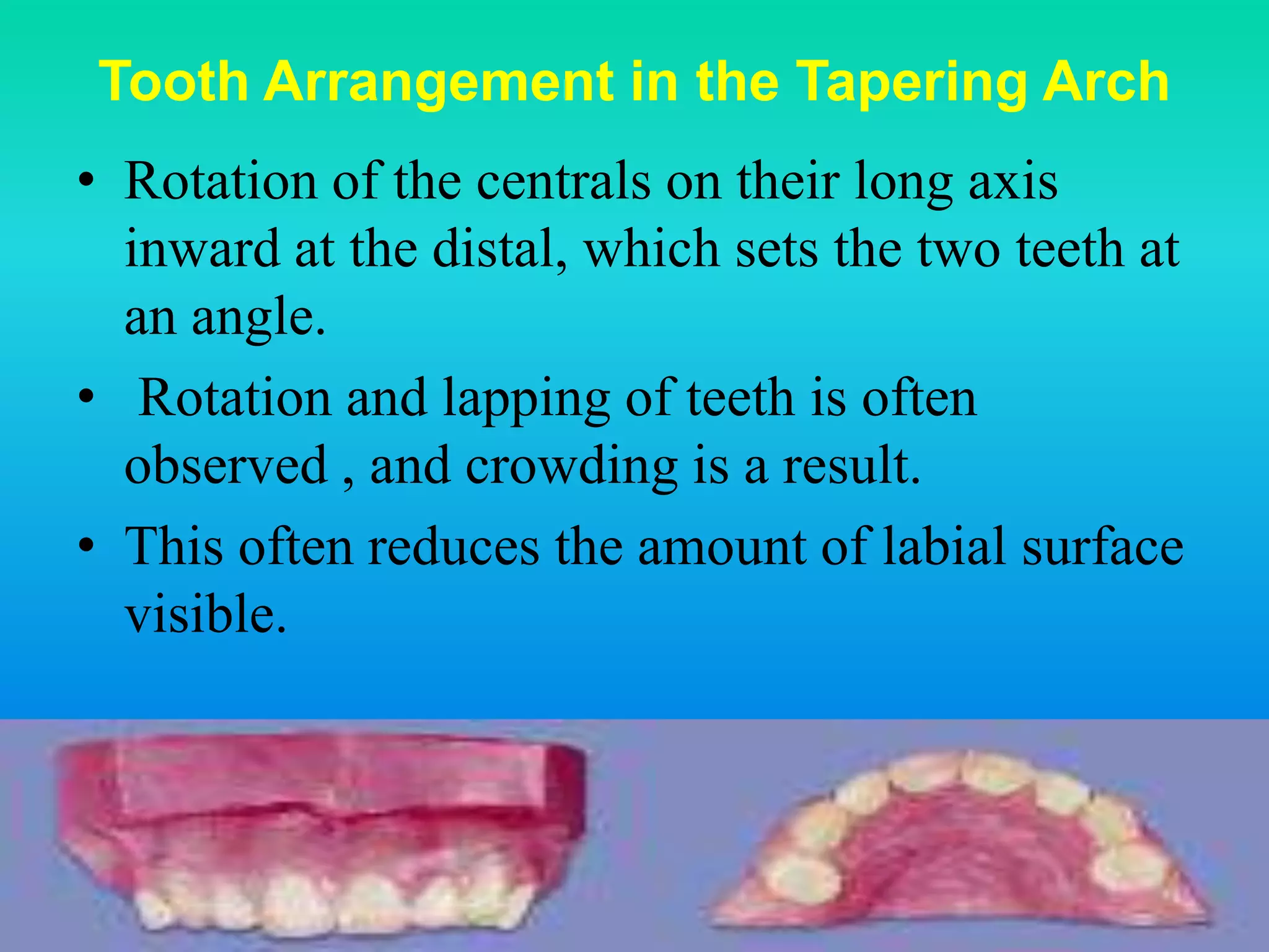 Arrangement of anterior artificial teeth | PPTX