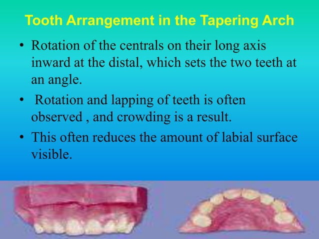 Arrangement of anterior artificial teeth | PPTX | Dental Health ...