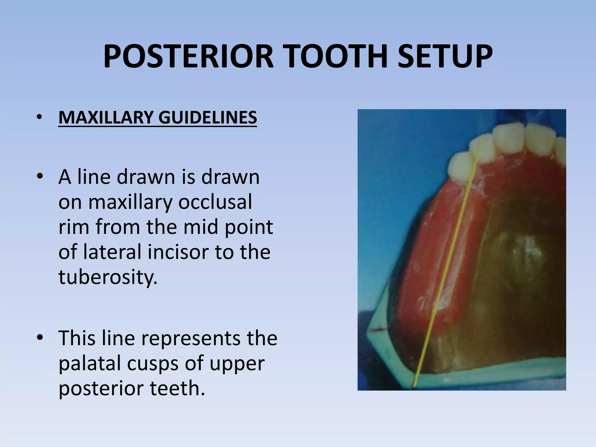 Arrangement of artificial teeth | PPTX