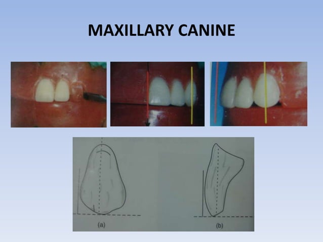 Arrangement of artificial teeth | PPTX