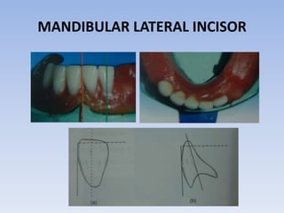 Arrangement of artificial teeth | PPTX