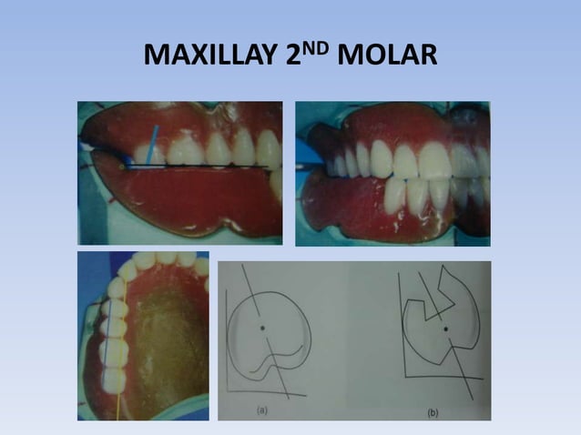 Arrangement of artificial teeth | PPTX