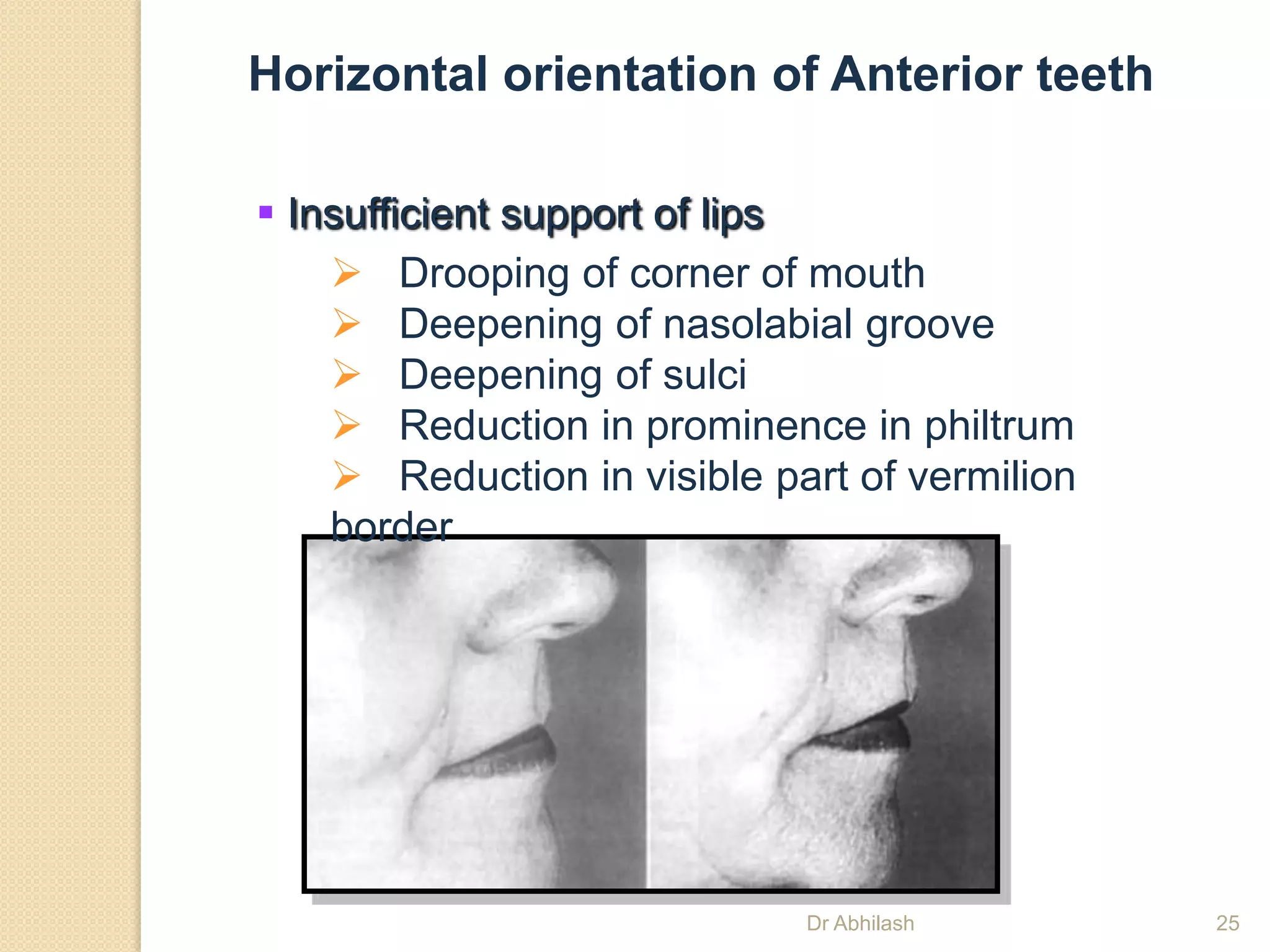 Arrangement of teeth in complete denture | PPTX