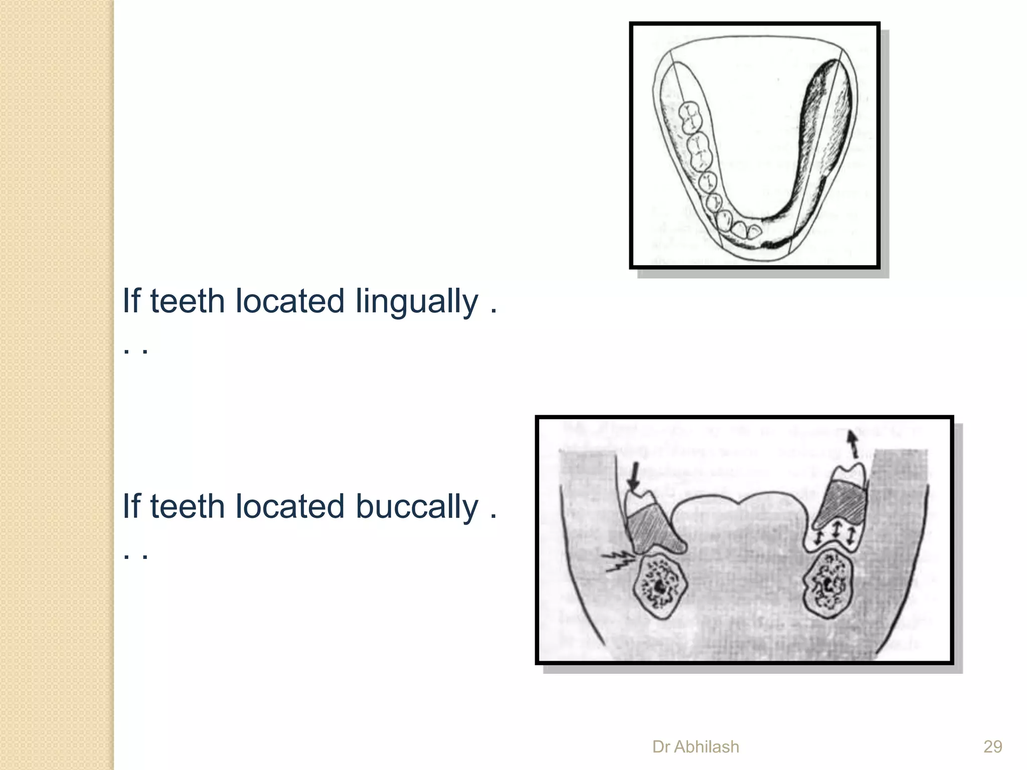 Arrangement of teeth in complete denture | PPTX