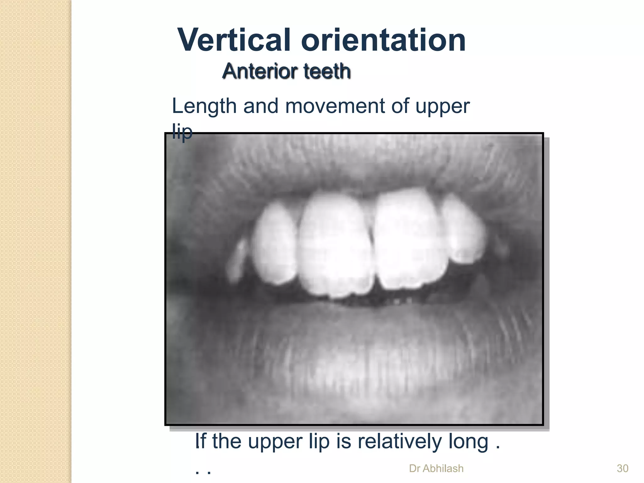 Arrangement of teeth in complete denture | PPTX