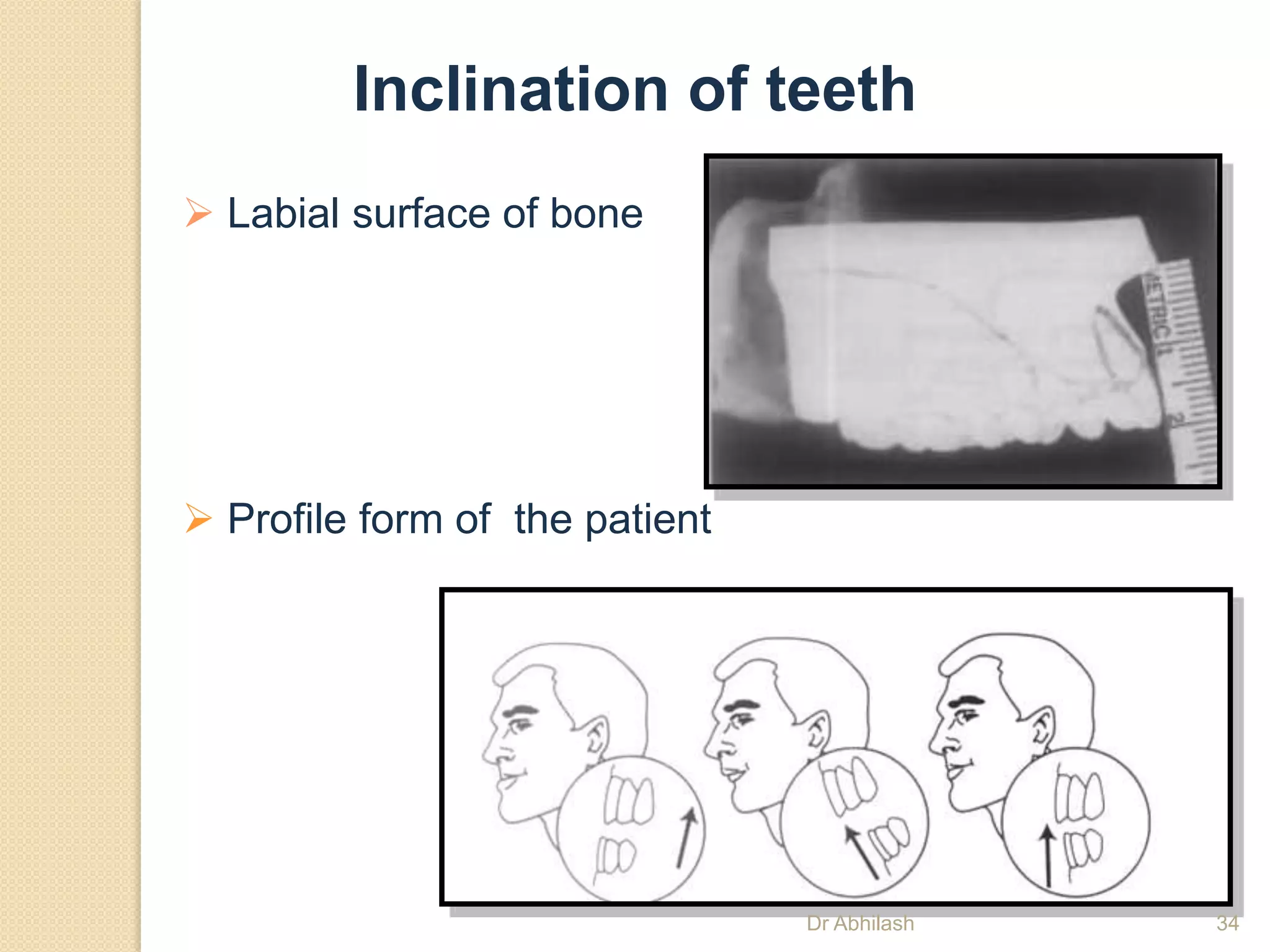 Arrangement of teeth in complete denture | PPTX