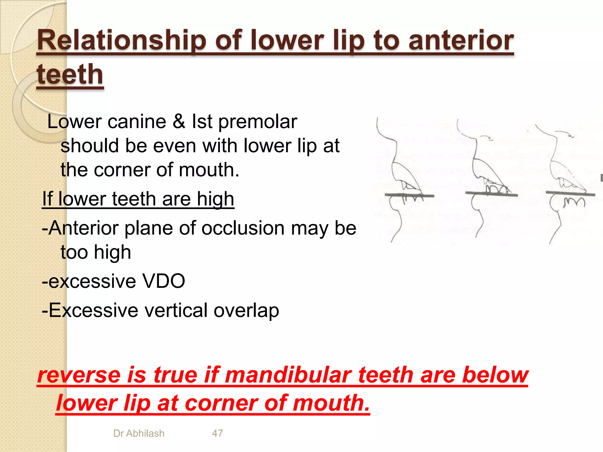 Arrangement of teeth in complete denture | PPTX