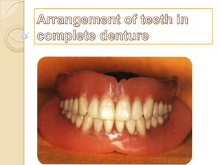 Arrangement of teeth in complete denture | PPTX