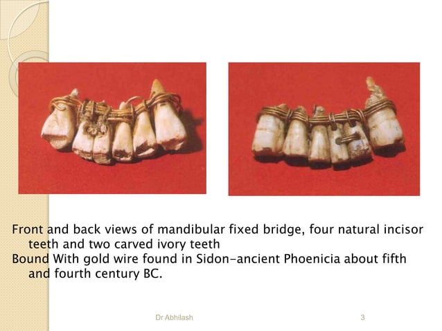 Arrangement of teeth in complete denture | PPTX