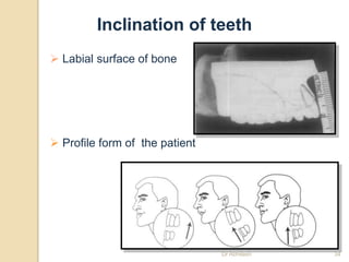Arrangement of teeth in complete denture | PPTX