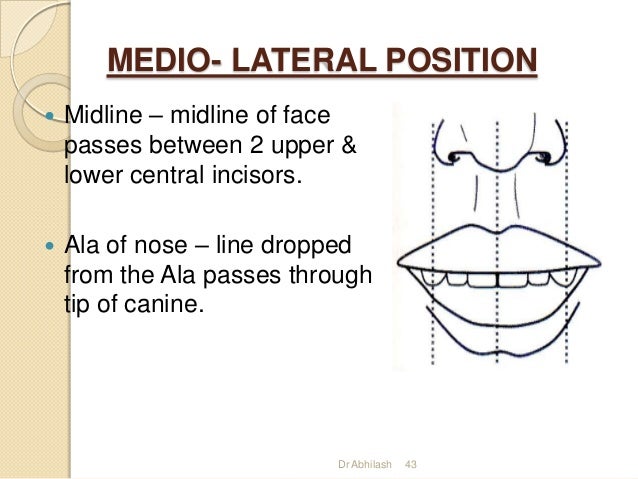 Arrangement of teeth in complete denture