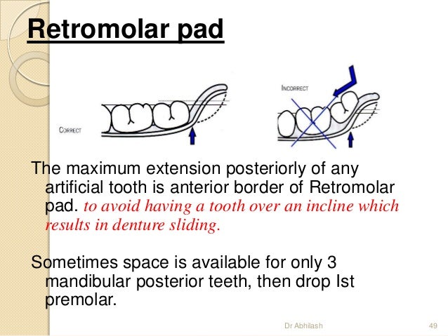 Arrangement of teeth in complete denture