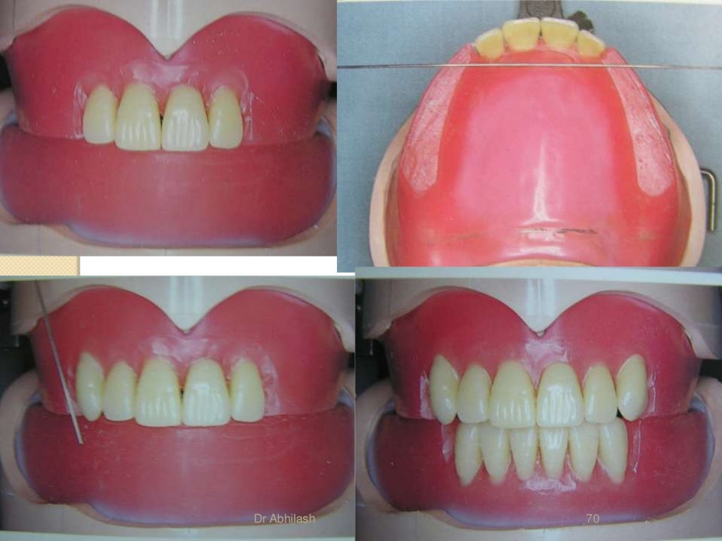 Arrangement of teeth in complete denture