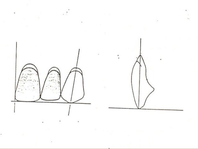 Arrangement of the anterior teeth1