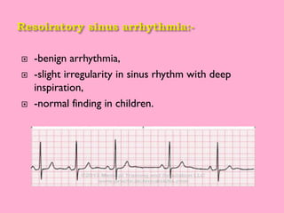 ARRHyTHMIA BY Dr./ Wafaa Ammar | PDF