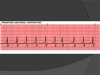 Arrhythmia | PPT