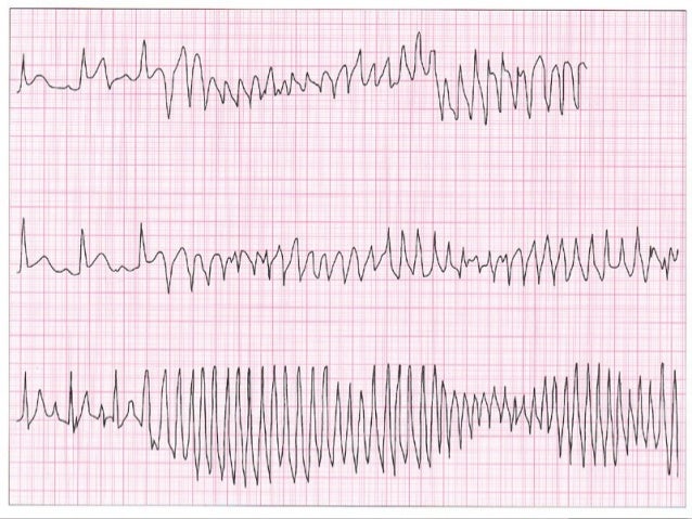Lethal Heart Rhythms
