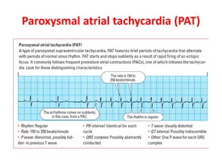 Paroxysmal Atrial Tachycardia Pat