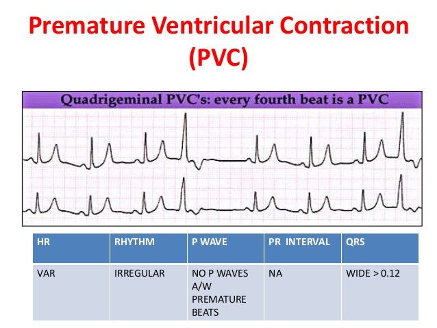 CARDIAC ARRHYTHMIAS