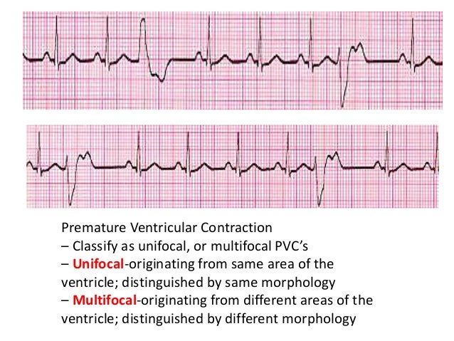 CARDIAC ARRHYTHMIAS