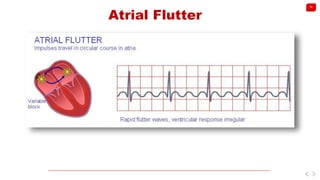 Management of cardiac arrhythmias | PPTX
