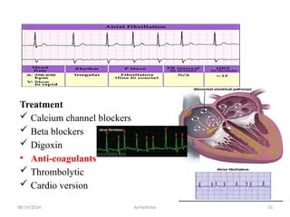 Arrhythmia.pptx power point presentations | PPT