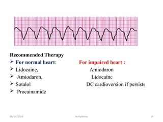 Arrhythmia.pptx power point presentations | PPT