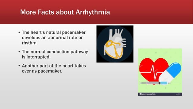 Arrhythmia cardiac catheterization holter_ | PPT