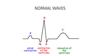 Arrhythmia for undergraduates | PPTX
