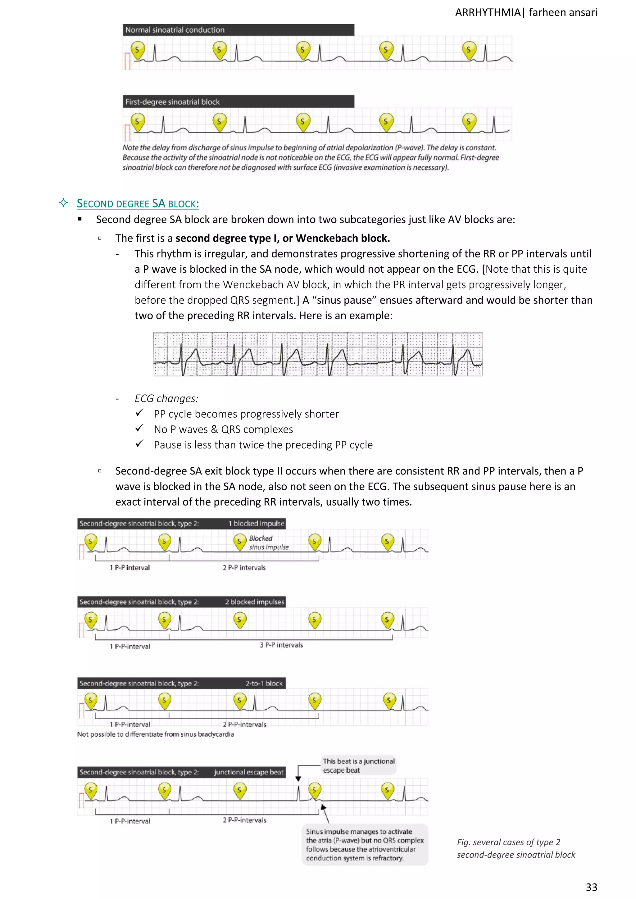 Arrhythmia: Mechanism, Classification, ECG features | PDF | Heart and ...