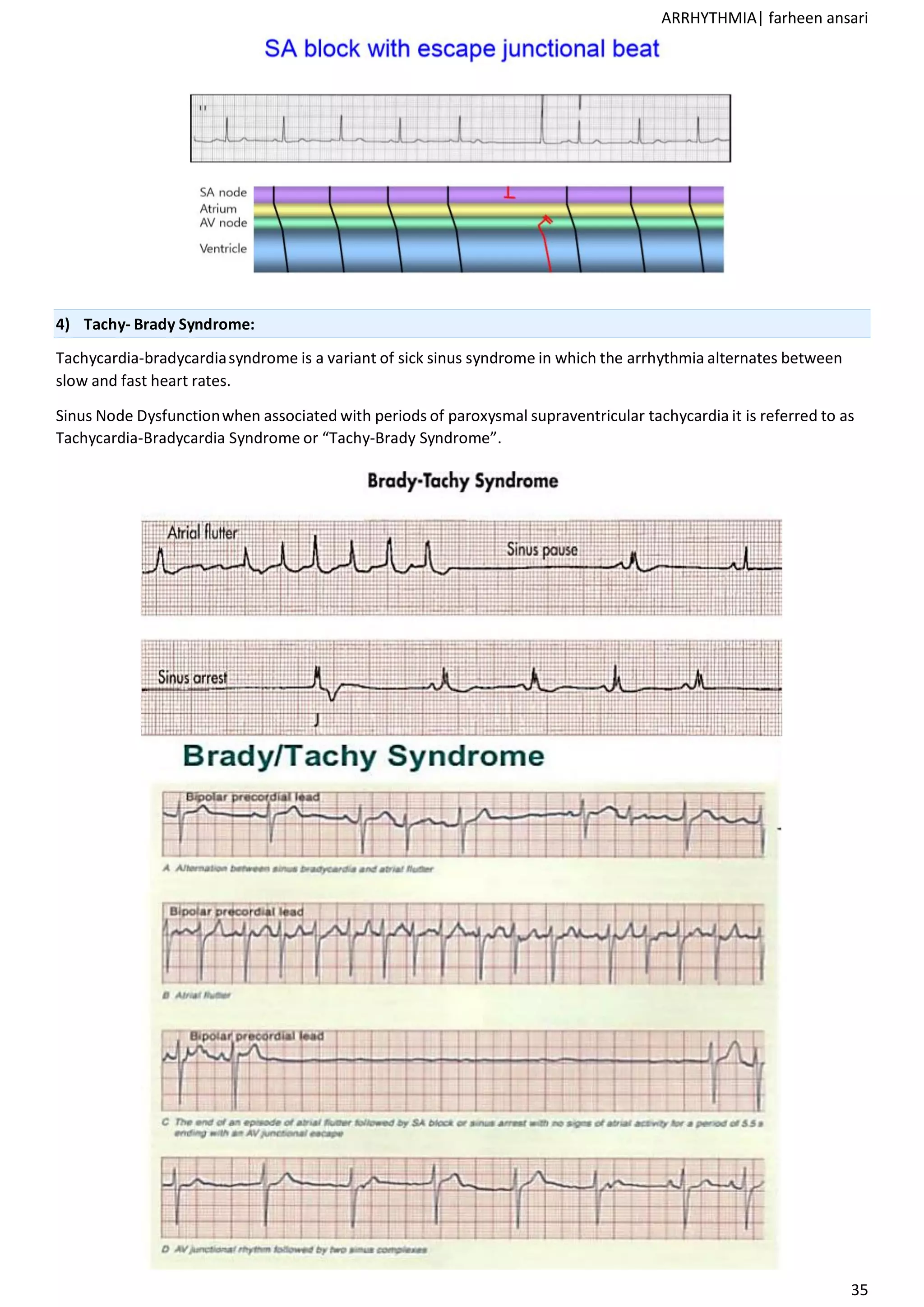 Arrhythmia: Mechanism, Classification, ECG features | PDF | Heart and ...