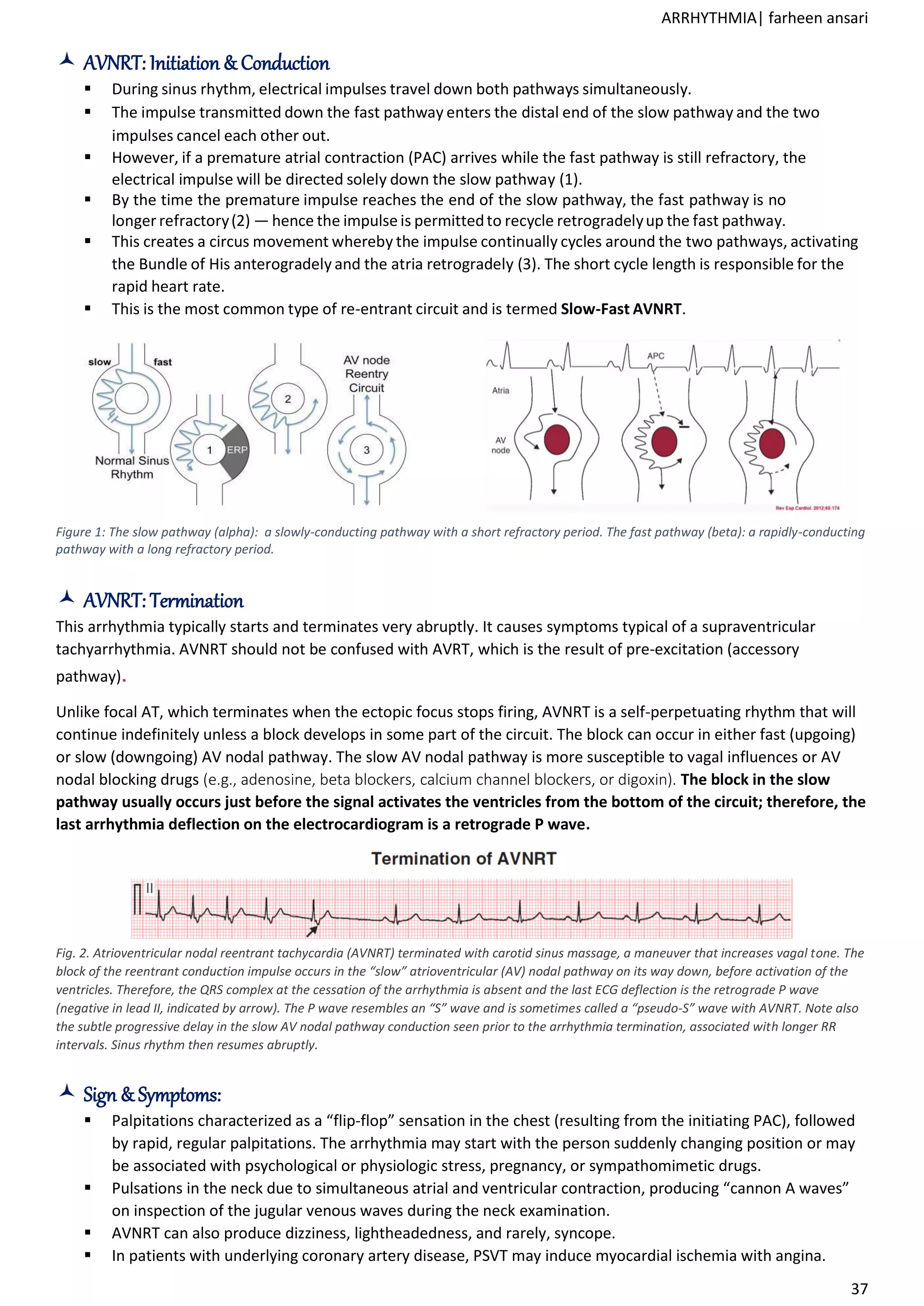 Arrhythmia: Mechanism, Classification, ECG features | PDF | Heart and ...