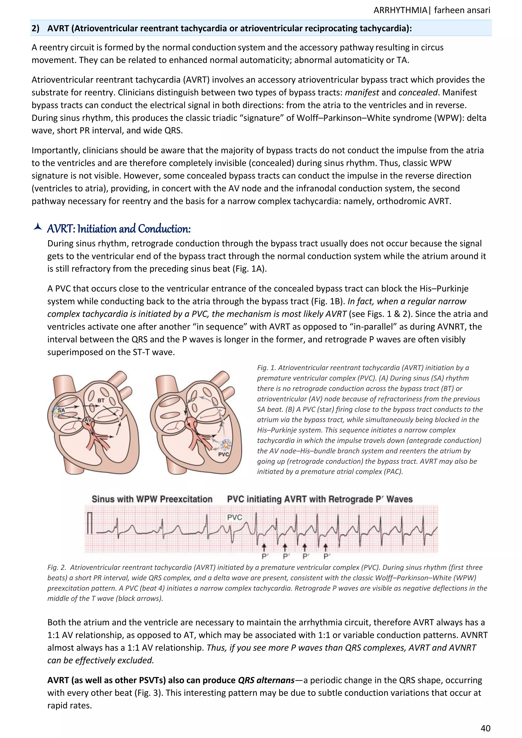 Arrhythmia: Mechanism, Classification, ECG features | PDF | Heart and ...