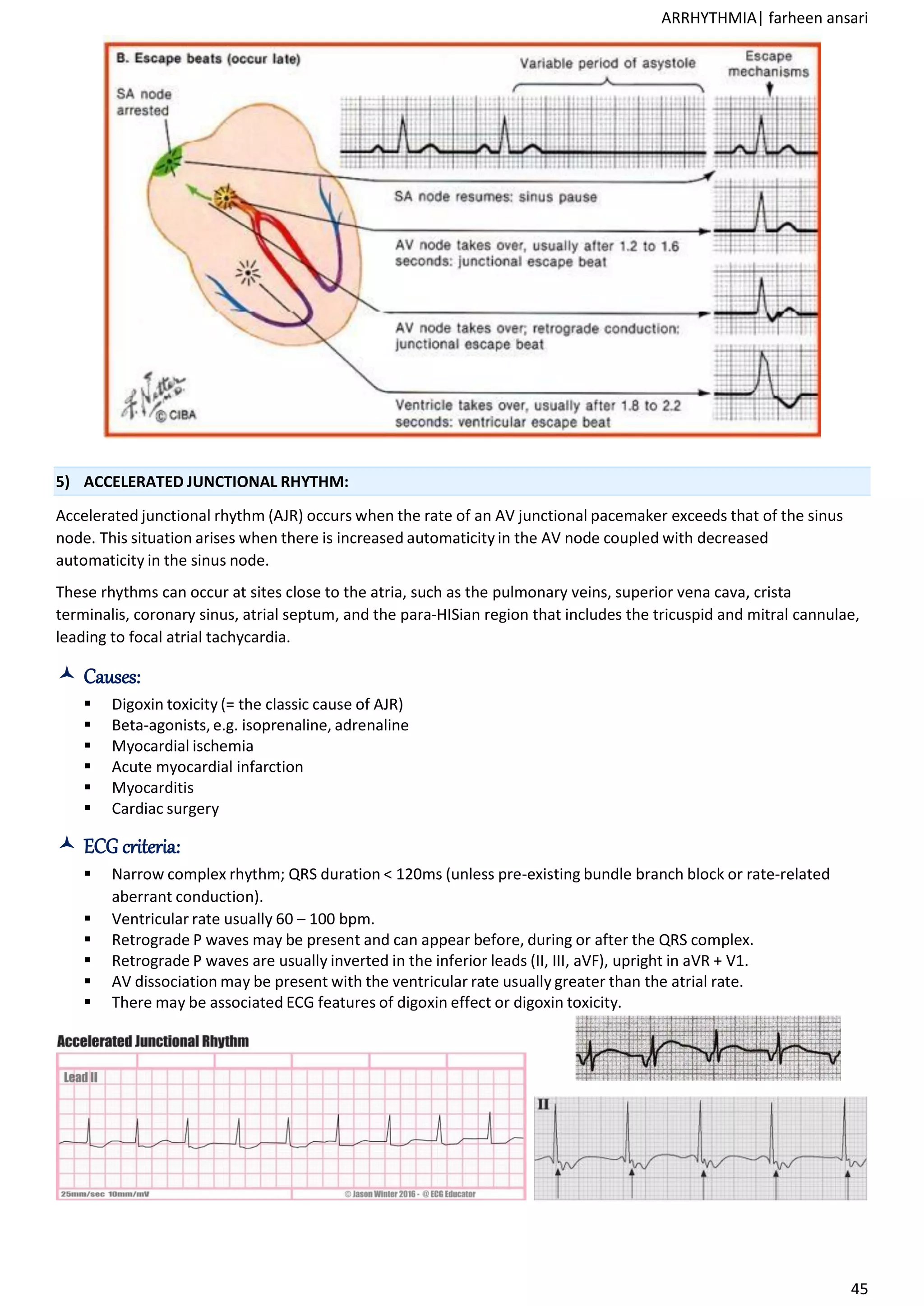 Arrhythmia: Mechanism, Classification, ECG features | PDF | Heart and ...