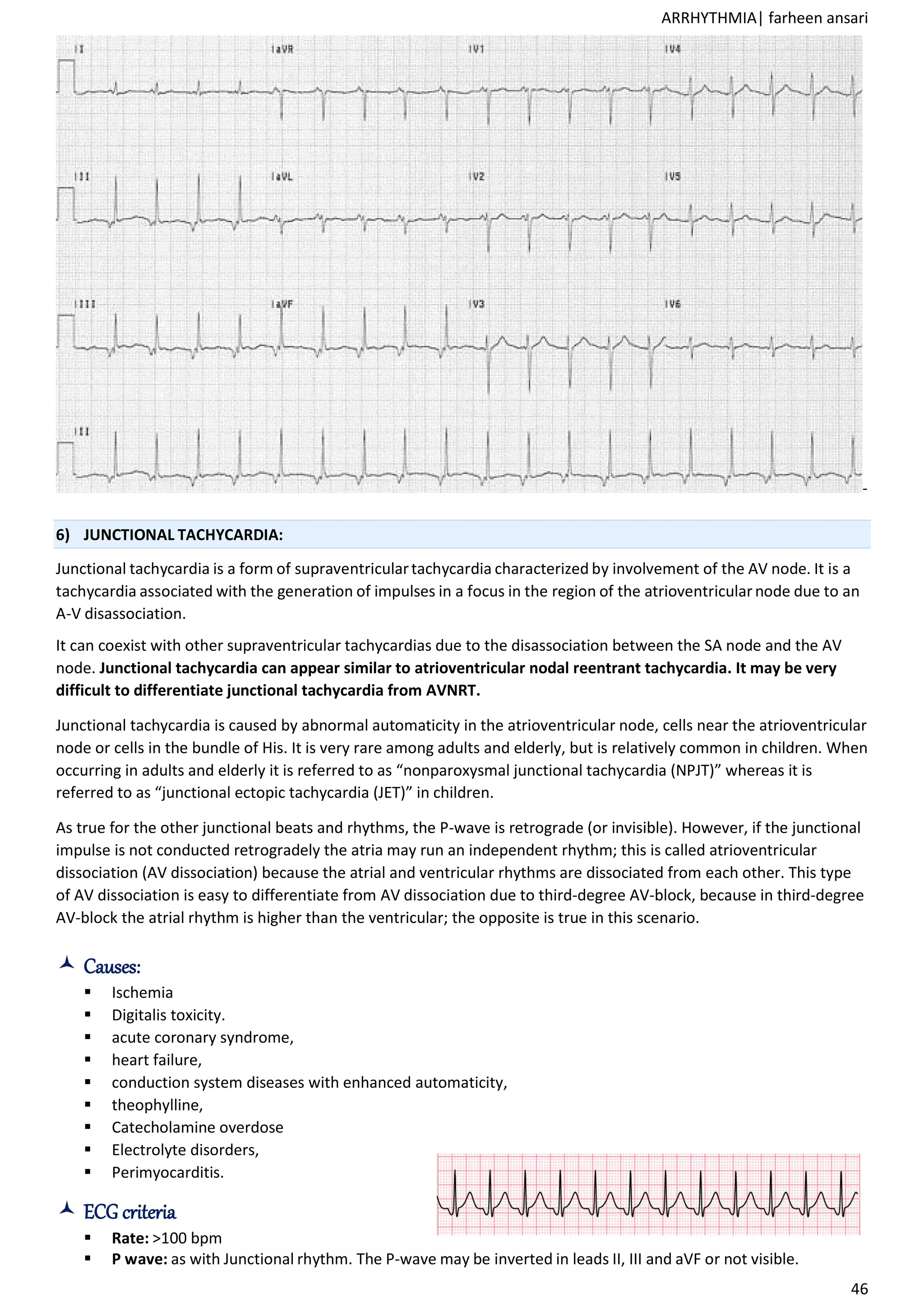 Arrhythmia: Mechanism, Classification, ECG features | PDF | Heart and ...