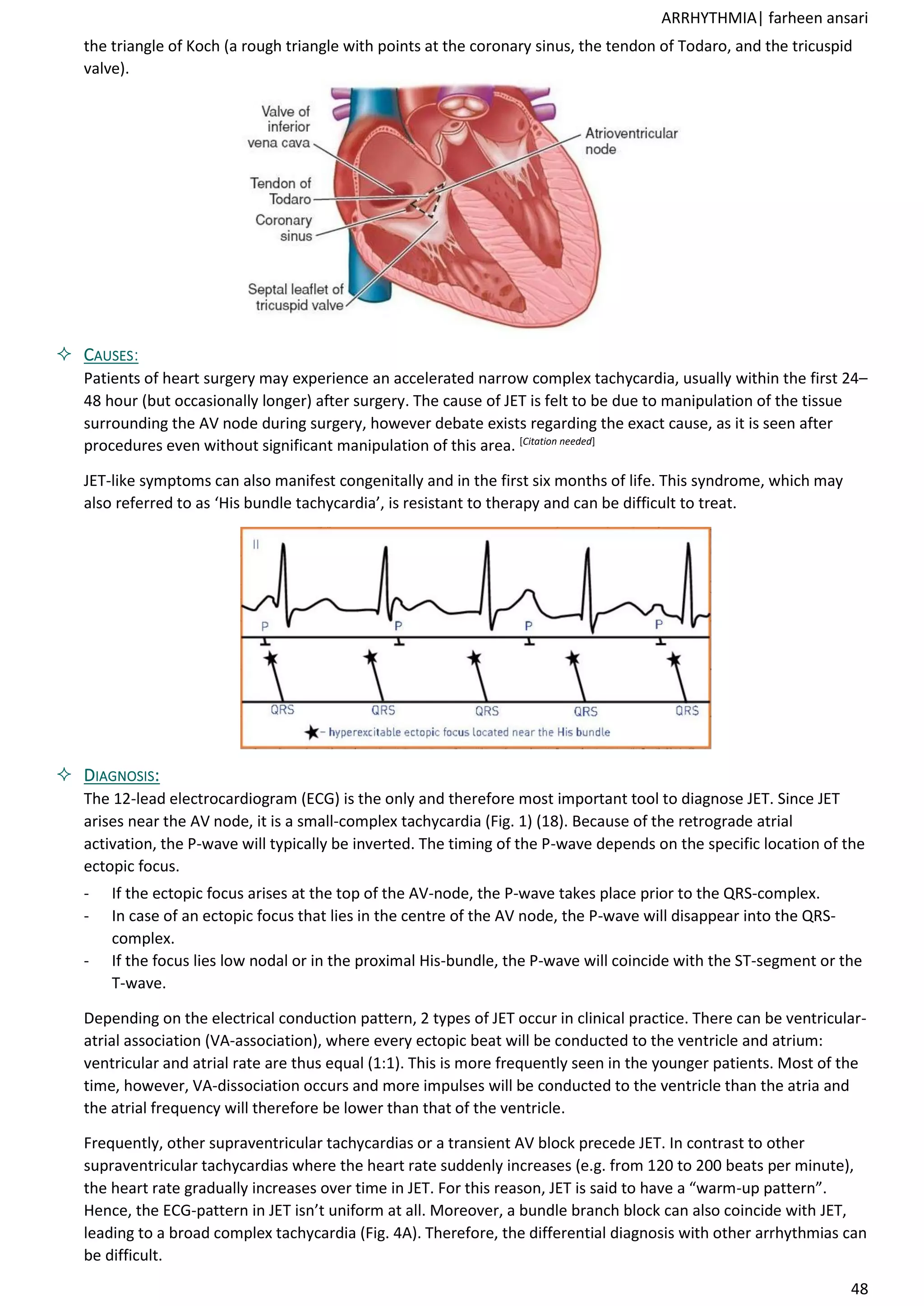 Arrhythmia: Mechanism, Classification, ECG features | PDF
