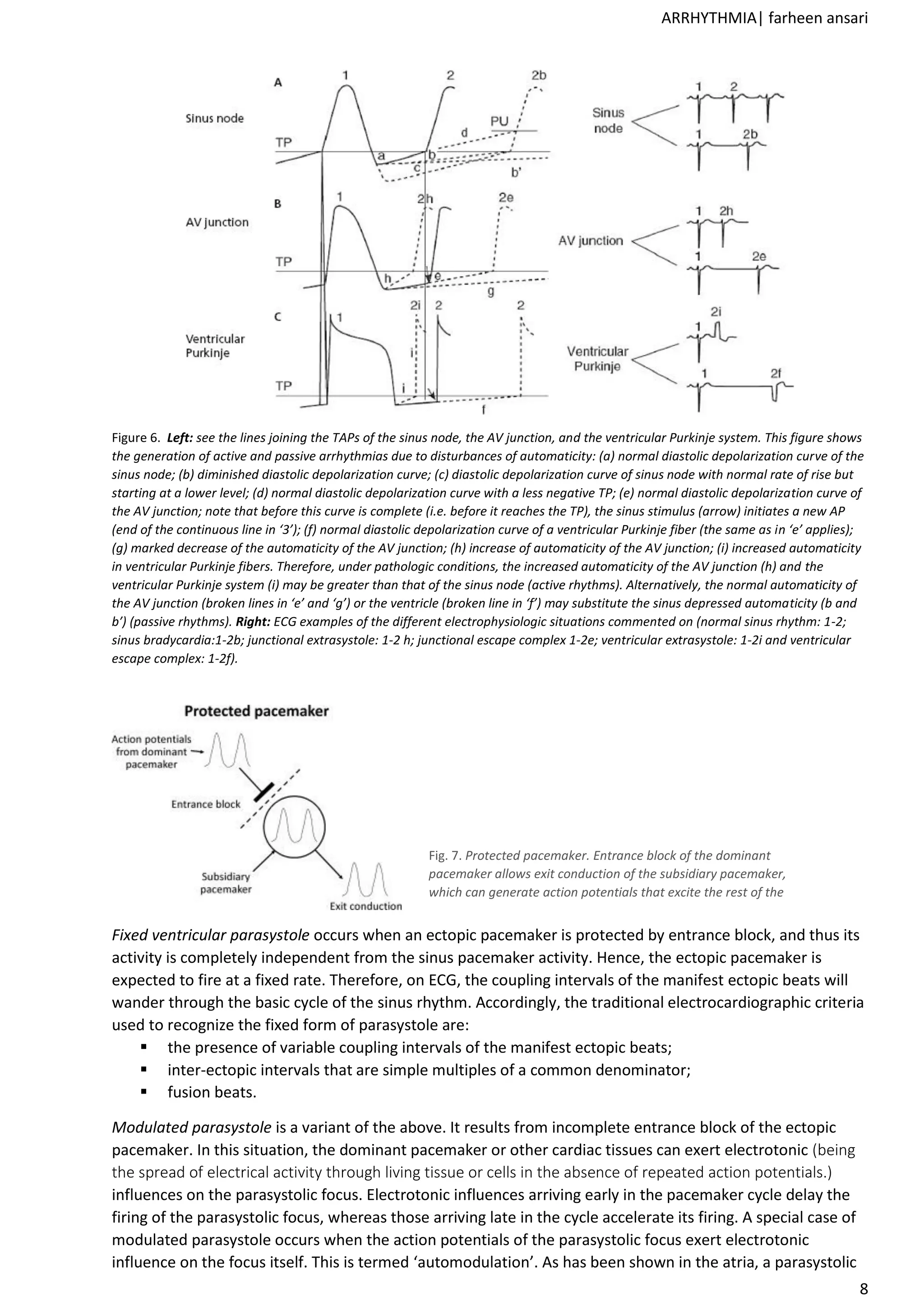 Arrhythmia: Mechanism, Classification, ECG features | PDF
