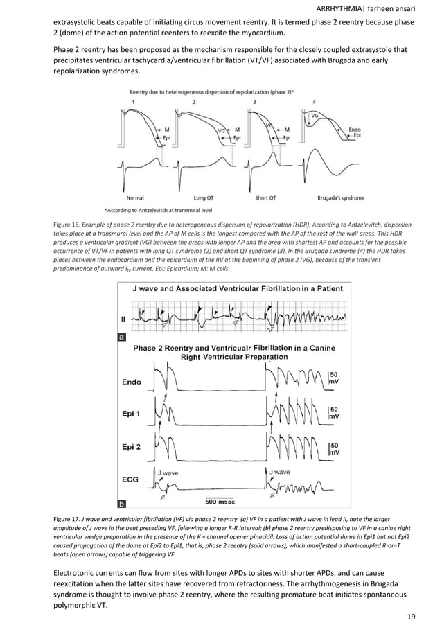 Arrhythmia: Mechanism, Classification, ECG features | PDF | Heart and ...