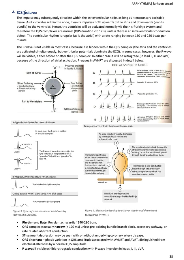 Arrhythmia: Mechanism, Classification, ECG features | PDF | Heart and ...