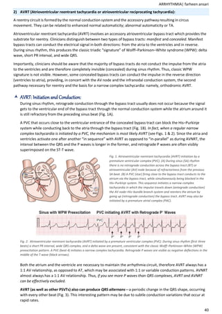 Arrhythmia: Mechanism, Classification, ECG features | PDF